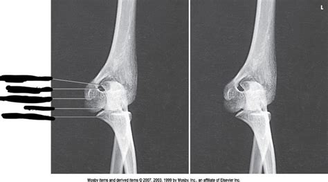 Ap Medial Oblique Elbow Diagram Quizlet