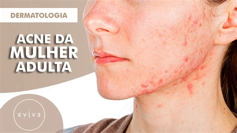 Acne Da Mulher Adulta YouTube