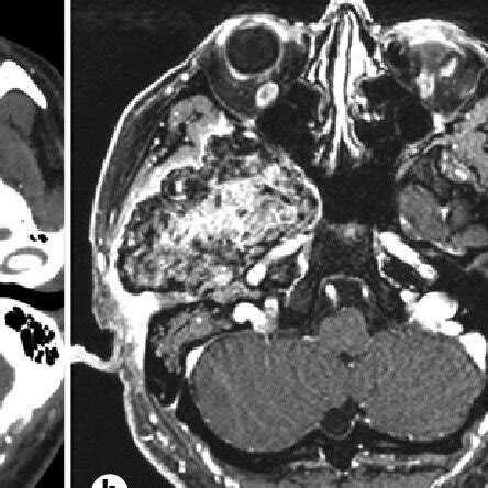 Computed Tomography CT And Magnetic Resonance Imaging MRI