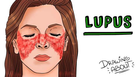 Qu Es El Lupus Draw My Life Youtube