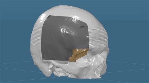 Modulare Trainingsmodelle In Der Neurochirurgie Kraniotomie