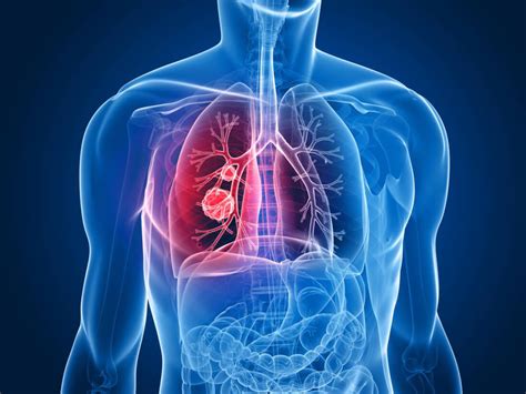 21 de Noviembre Día Mundial de la Enfermedad Pulmonar Obstructiva