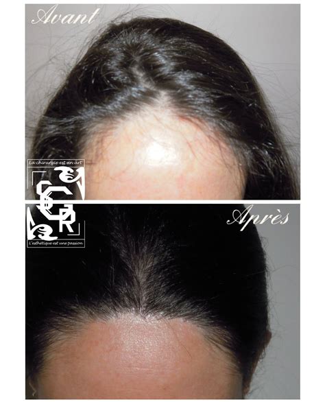 Chirurgie Capillaire Greffe De Cheveux Lyon Implants Capillaires