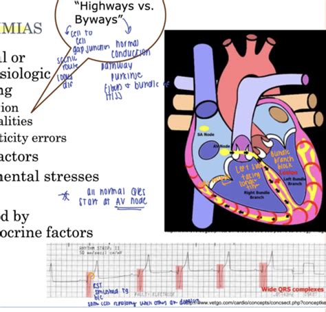 Arrhythmias Flashcards Quizlet