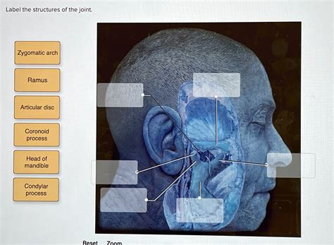 Label The Structures Of The Joint Zygomatic Arch Coronoid Process