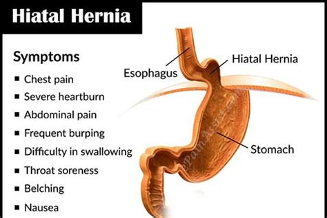 Hiatus Hernia Types Causes Symptoms Complications 47 OFF