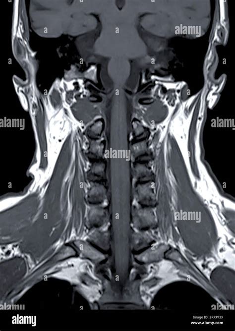 Imagen de resonancia magnética de columna cervical Vista coronal para