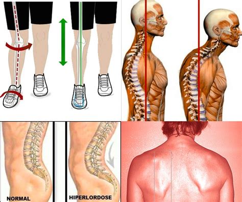 Muscula O Aplicada A Melhora Dos Desvios Posturais Como Treinar