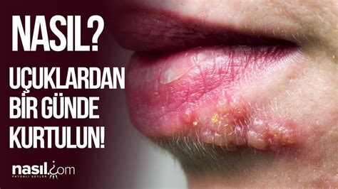 UÇUK NEDEN ÇIKAR UÇUK NASIL GEÇER İŞTE UÇUĞA İYİ GELEN DOĞAL