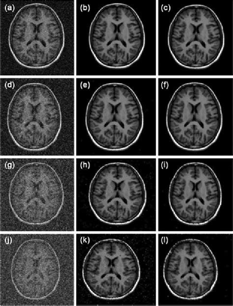 figure 1 from a circular adaptive median filter for salt and pepper noise suppression from mri