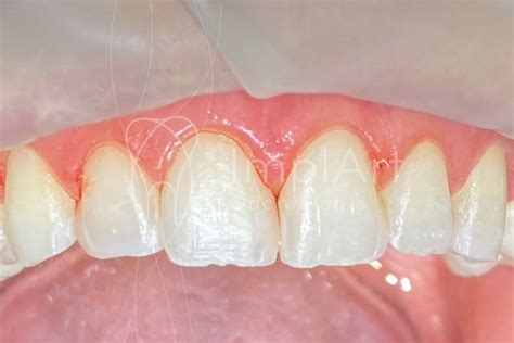 Preparo Dente Para Lente De Contato Dental Kb Cl Nica Odontol Gica