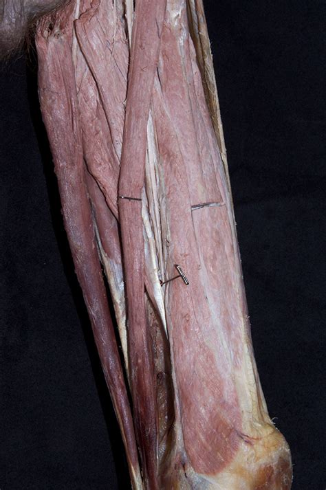 Adductor Brevis Cadaver