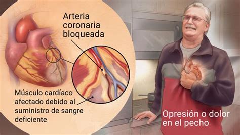 Infarto Agudo Al Miocardio