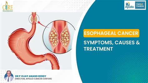 Esophageal Cancer Symptoms Causes Treatment Dr Vijay Anand Reddy
