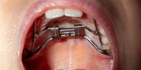 Expansor del paladar Para qué se usa
