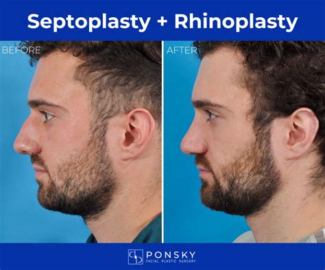 Deviated Septum Surgery Everything You Need To Know