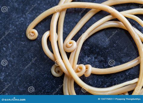 Ascariasis Is A Disease Caused By The Parasitic Roundworm Ascaris