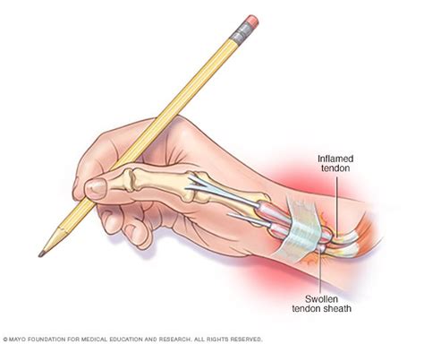 De Quervain S Tenosynovitis Symptoms Causes Diagnosis And Treatment