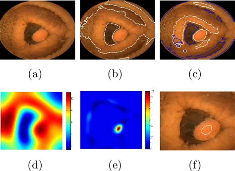 figure 3 from automatic detection and segmentation of colonic polyps in wireless capsule images