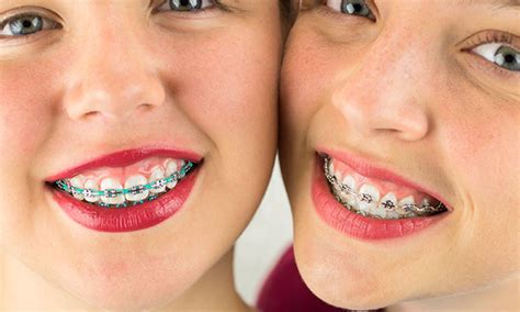 Colored Braces Rubber Bands