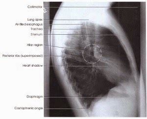 Lateral Chest Radiograph Anatomy