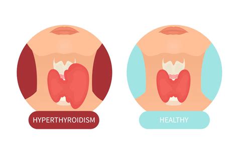 Hyperthyroidism What Happens If The Thyroid Is Working Too Much