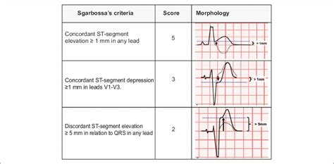 STEMI ST Elevation Myocardial Infarction Diagnosis
