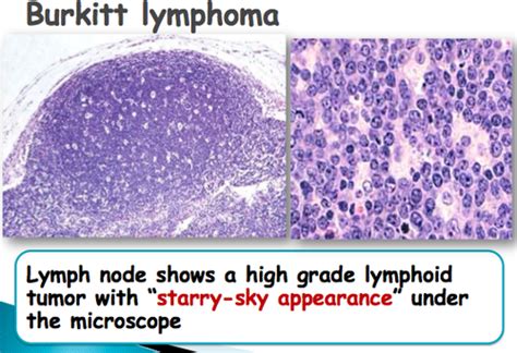 Neoplasia Flashcards Quizlet