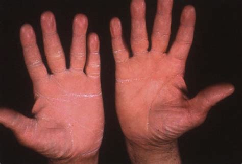 Tinea Corporis Hand