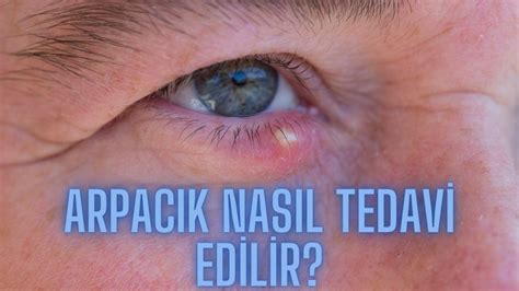 Arpacık nedir Arpacık neden olur Arpacık nasıl tedavi edilir