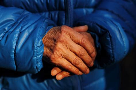 Does Cracking Knuckles Really Cause Arthritis Doctor Solve