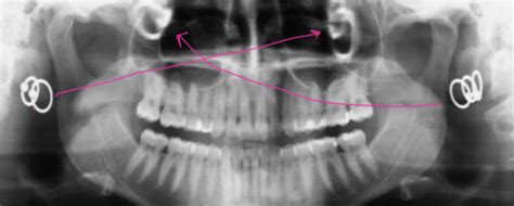 Interpretation Of Panoramic Radiography Flashcards Quizlet