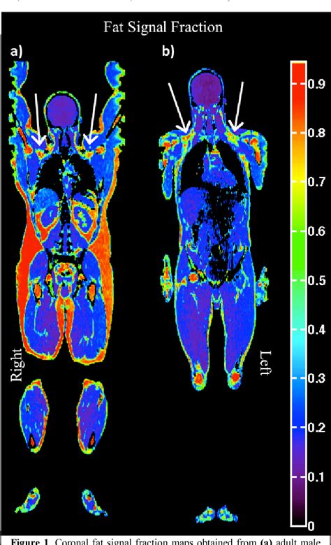 Figure 1 From Preliminary Indication Of Brown Adipose Tissue In Adult Humans Using Fat Water Mri