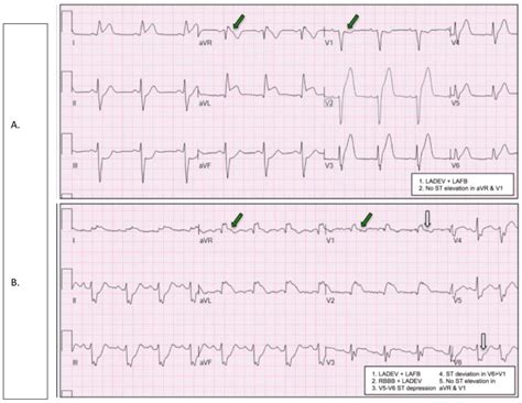 EKG Pattern Favoring Total Occlusion Of LM From Proximal Left Anterior