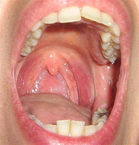Normal Throat Bumps
