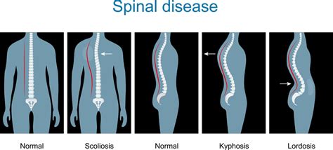 Understanding Spinal Curvatures Kyphosis Lordosis And Scoliosis The