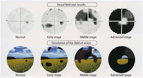 Glaucoma Visual Field Defects