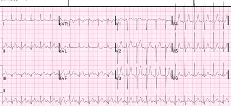 Dr Smith S ECG Blog Tachycardia Dehydration And New ST Elevation In