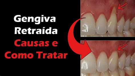 Retração Gengival Causas Sintomas e Tratamento Como Tratar a
