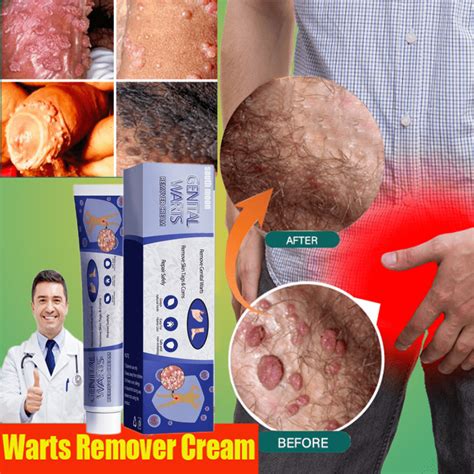 Ubat Buang Kutil Ketuat Tahi Lalat Biji Kolestrol Mole Removal Wart