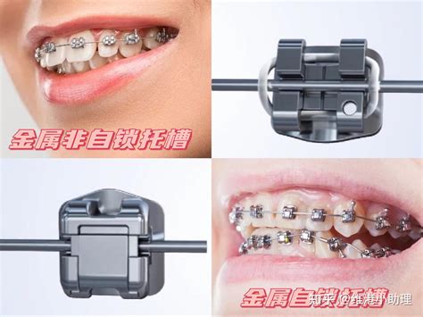 深圳牙齿矫正医生科普丨不同牙齿矫正器的区别丨传统金属VS金属自锁丨隐形牙套隐适美 时代天使 正雅差别丨你想知道的整牙知识都在这里 知乎
