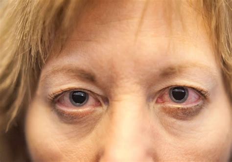 What Drugs Cause Dilated Pupils
