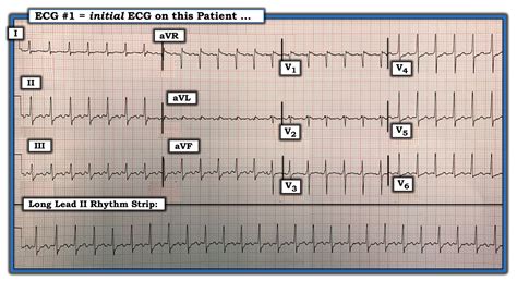 Dr Smith S ECG Blog What Is This Regular SVT