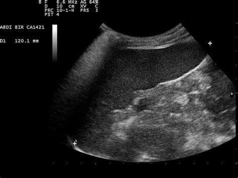 Spleen Ultrasound Of Abdomen Flashcards Quizlet