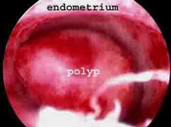 Hysteroscopy Polyp