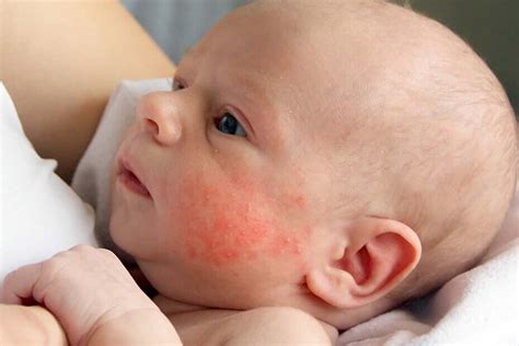 Baby Eczema Does My Baby Have Eczema Pure Medical