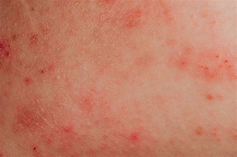 13 Causas de las manchas rojas rosadas o marrones en la piel según