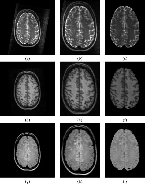 figure 1 from an automatic segmentation of t2 flair multiple sclerosis lesions semantic scholar