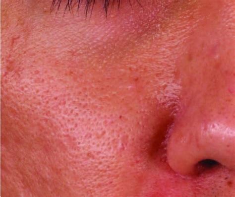 Enlarged Pores SkinPen Precision By Crown Aesthetics