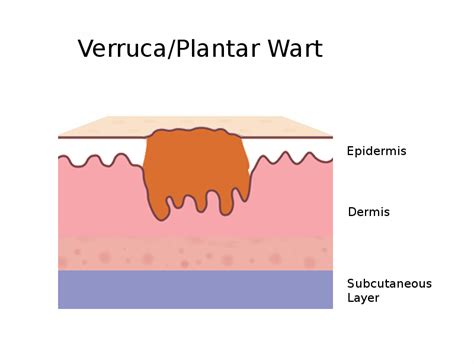 Plantar Wart Root Diagram Bruin Blog